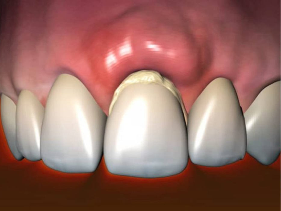 Diş Apsesi Nedir ? Konya | Dentium Ağız ve Diş Sağlığı Polikliniği
