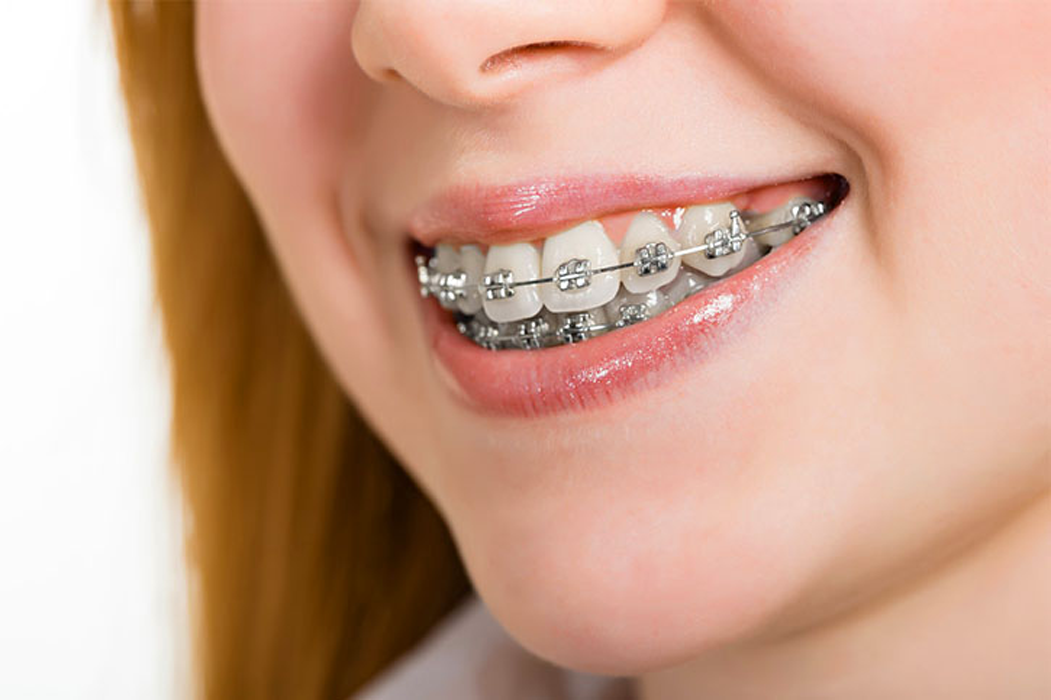 Ortodonti Tedavisi Sonrası Dişler Eski Haline Döner mi? | Dentium Ağız ...